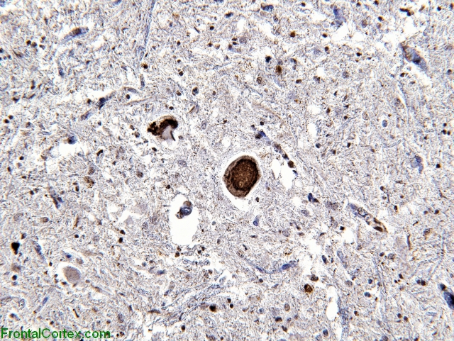 ALS anterior horn cells ubiquitin UHC x200