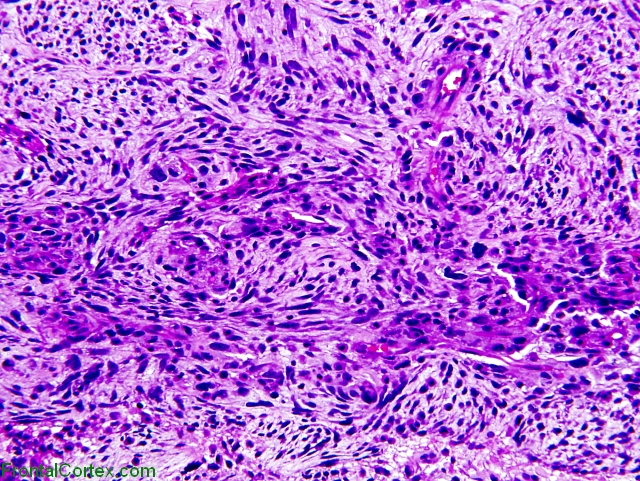 Gliosarcoma (glioblastoma multiforme with prominent spindle cell ...