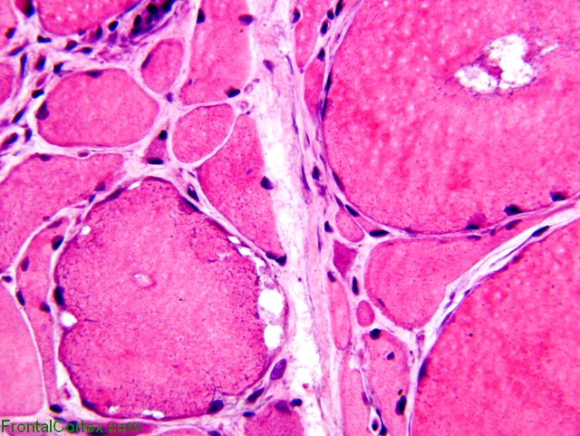 Inclusion body myositis, H&E stain x400