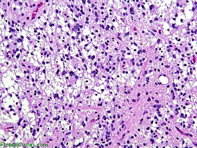 Adult Brain Tumor Pathology 01
