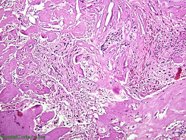 Tanycytic ependymoma x200