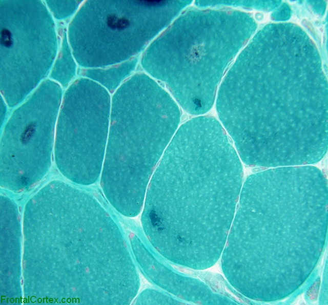 Gomori trichrome stain: hyaline inclusions x200